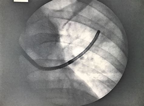 La Diagnosi Del Tumore Ai Polmoni Arriva Un Nuovo Strumento