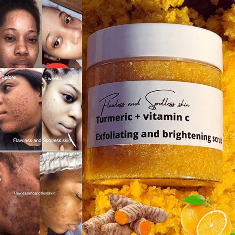 Natural Ways To Remove Black Spots On Skin Acne