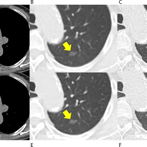 A Woman Received Low Dose Chest Ct For The Follow Up Evaluation Of A Download Scientific