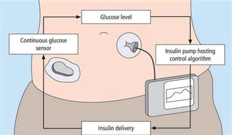 benefits and risks of insulin pumps and closed loop delivery systems