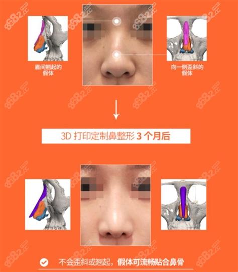韩国歌柔飞隆鼻怎么样鲁峰一风格自然金在仁华丽鼻实例多鼻部对比照 8682整形网