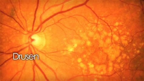 Drusen Small Deposits In The Retina From Macular Degeneration