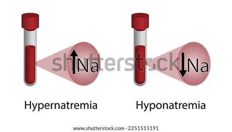 Hypernatremia High Plasma Sodium Level Hyponatremia Stock Vector Royalty Free 2251515191