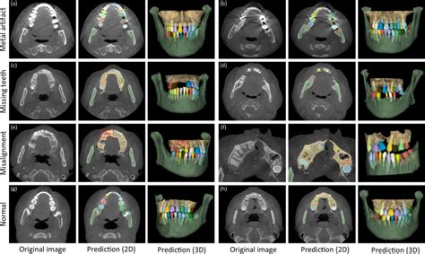 A Fully Automatic Ai System For Tooth And Alveolar Bone Segmentation From Cone Beam Ct Images Pmc