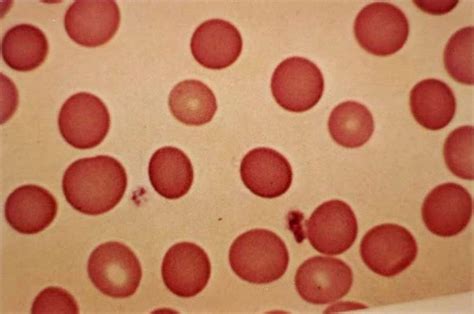 Esferocitose Hereditária Biomedicina Padrão