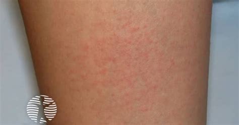 Contact Allergic Dermatitis Of The Arms And Legs Image