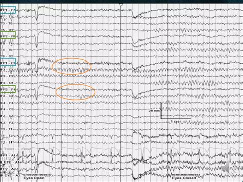 Eeg Basic To Practice 2 Pptx