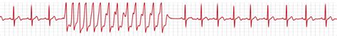 Heartbug Australia S Friendliest Heart Monitoring Service