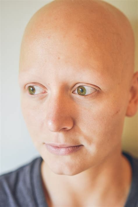 Alopecia Universalis Woman