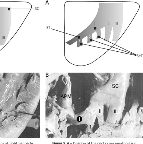 Structure Of Trabecula Septomarginalis Semantic Scholar