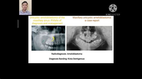 Journal Reading Maxillary Unicystic Ameloblastoma Alfa Sinaga