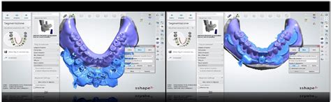 Superimposition Of The Original Prosthetic Project And Of