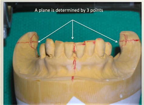 Occlusal Plane Analysis And Master Cast Modification Flashcards Quizlet