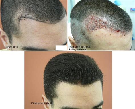 Dr Christian Bisanga Bhr Clinic 1508 Fue And 95 Plug Redistribution Via