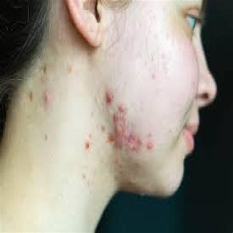 Acne Detection YOLOv Object Detection Dataset By FYP Acne Detection