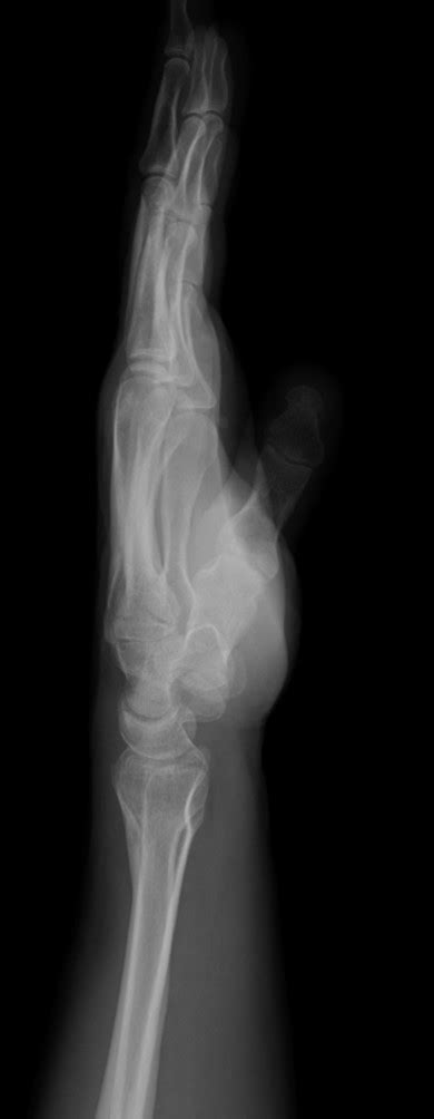 Wrist Arthroscopy Turkey Case 22 Scaphoid Pseudoarthrosis