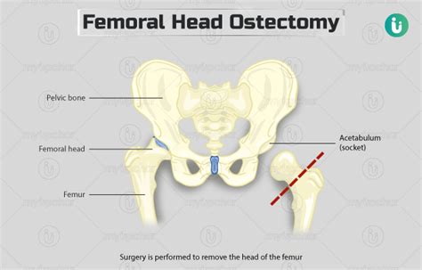Femoral Head Ostectomy Procedure Purpose Results Cost Price