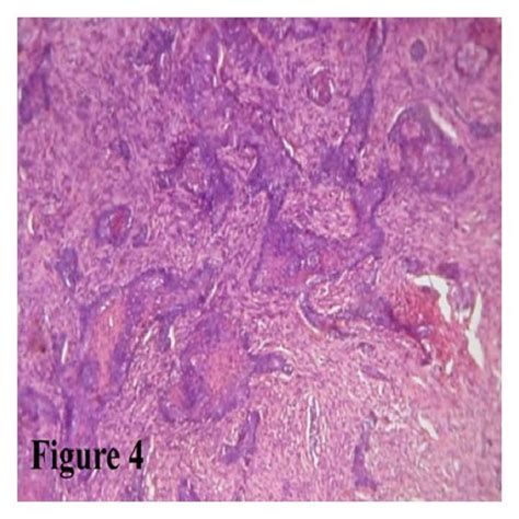 H And E Stained Section Shows Ameloblastic Follicles With Basaloid