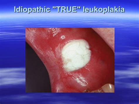 White Lesions Ppt Ppt