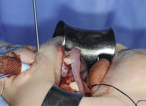 Figure 1 From Stabilisation Of Premaxillary Segment In Bilateral Cleft