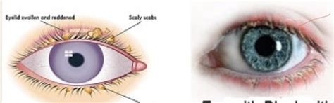 Ophtha Eyelid Blepharitis Flashcards Quizlet