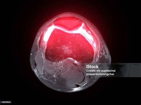 전방십자인대의 파열 또는 염좌를 감지하기 위한 무릎 관절 Axial T2 Fs 보기의 자기 공명 영상 또는 Mri 0명에 대한