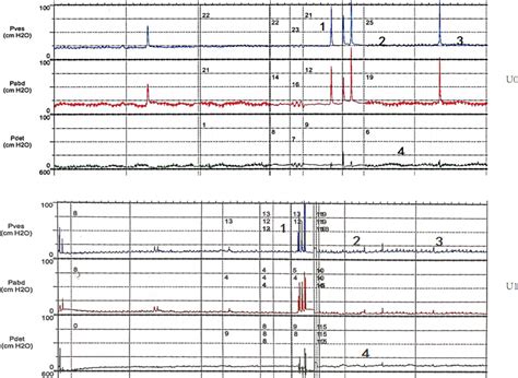 A Specimen Urodynamic Test Was Performed 1 Week Before The Operation