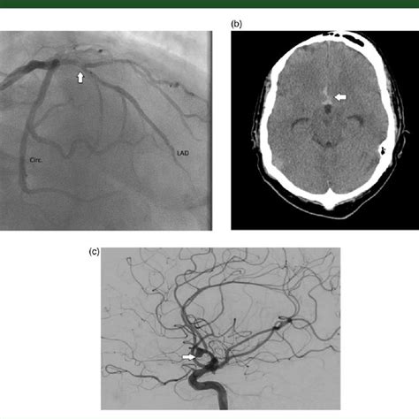 A Thrombotic Subtotal Occlusion Of The Mid Left Anterior Descending Download Scientific