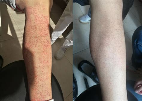 4剂中药治愈单纯性过敏性紫癜 医界动态 青岛大众网