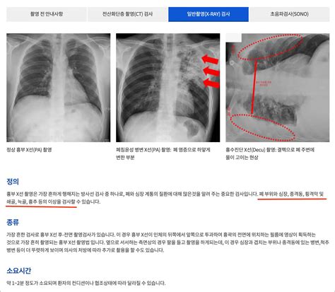 흉부 엑스레이 사진으로 뭘 알 수 있나요 Sepialy