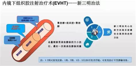 【中山医“声”】寻根溯源，精准止血——食管胃静脉曲张破裂出血内镜下治疗 湖北省第三人民医院