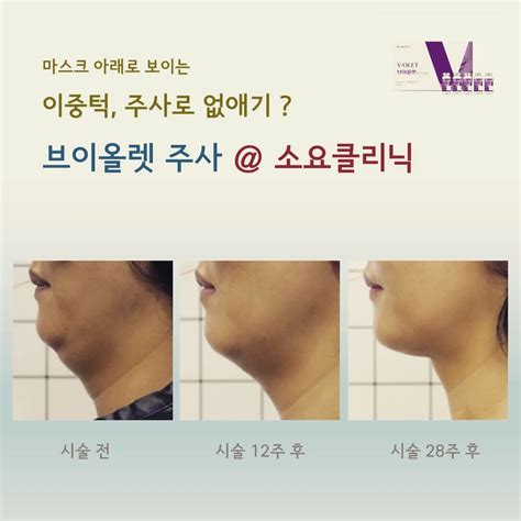 Soyo Clinic 이중턱 없애는 🍾 브이올렛 주사 소요클리닉 에서 안전하게 👨‍⚕️👩‍⚕️ ⠀ Kfda가 승인한 데옥시콜린산 효소 성분 👍👍 수술 없이 간단한