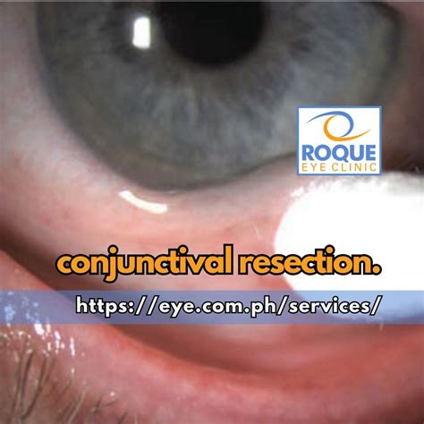 Conjunctival Resection Roque Eye Clinic Ph