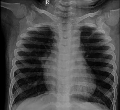 Chest X Ray Showing Mild Cardiomegaly And Very Minimal Pulmonary Plethora Download Scientific