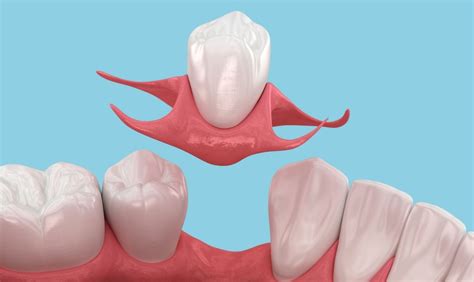 Guide To Single Tooth Denture Costs How They Stay In And Types