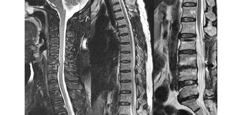 Epidural Abscess Is Disappeared On Follow Up Postoperative 7 Months Download Scientific