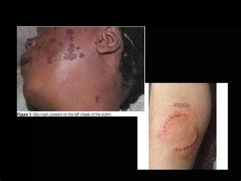 bite marks forensic dentistry ppt