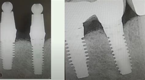 Implant Prosthetic Complications Prevention Guide Part 2