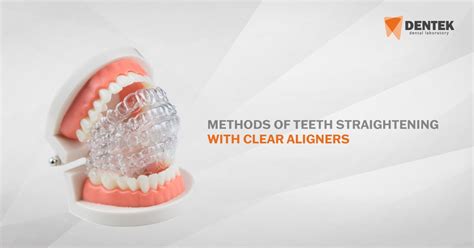Methods Of Teeth Straightening With Clear Aligners