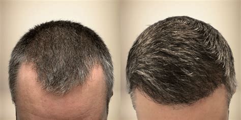Pdo Threads North Atlanta Hair Restoration