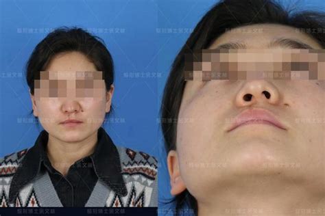 唇裂修复术后出现鼻畸形该怎么修复 知乎