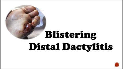 Blistering Distal Dactylitis Youtube