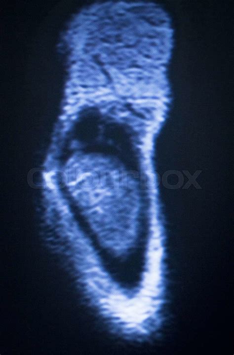 Mri Magnetic Resonance Imaging Elbow Arm Scan Stock Image Colourbox