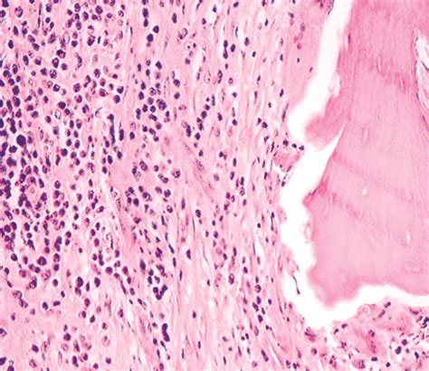 Pathology Outlines Chronic Osteomyelitis
