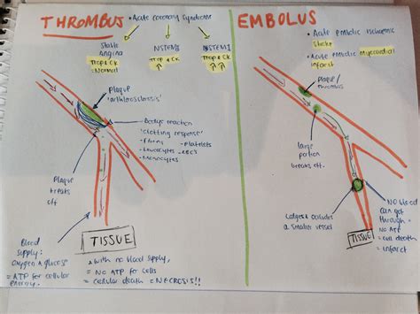 Understanding Thrombus And Embolism