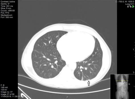 Atypical Marantic Endocarditis Pmc