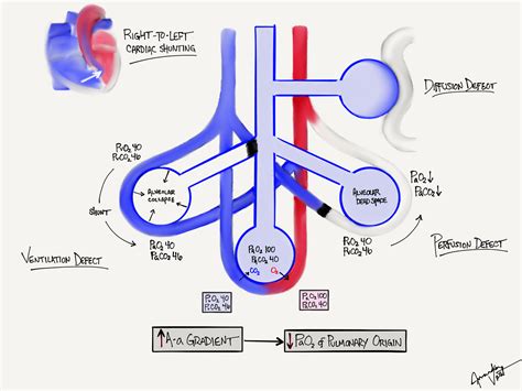 Usmle Wizard Hypoxemia With An Increased A A Gradient A A