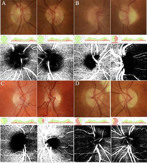 Optic Nerve Head Onh Photo Corresponding Retinal Nerve Fibre Layer