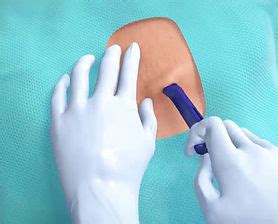 Implantable Loop Recorder Doctorleyva