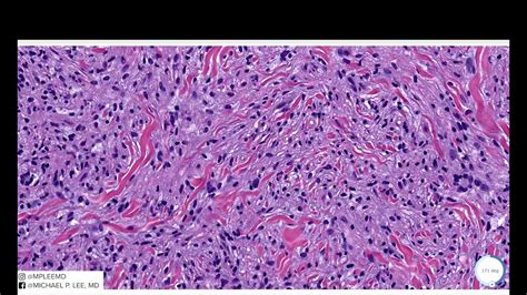 Juvenile Xanthogranuloma Histology Juvenile Xanthogranuloma Histology